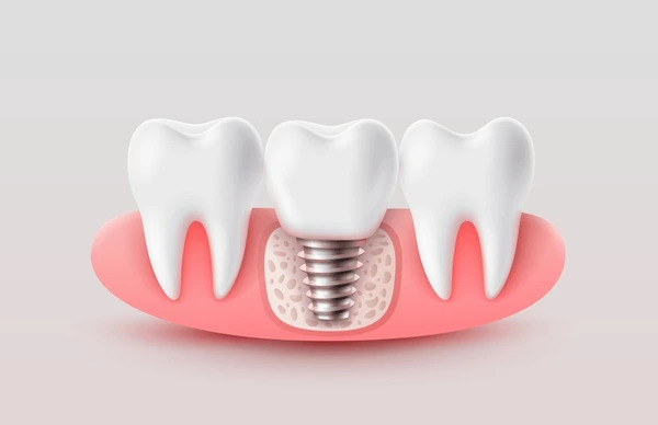 What Are The Major Factors Behind Failed Dental Implants?